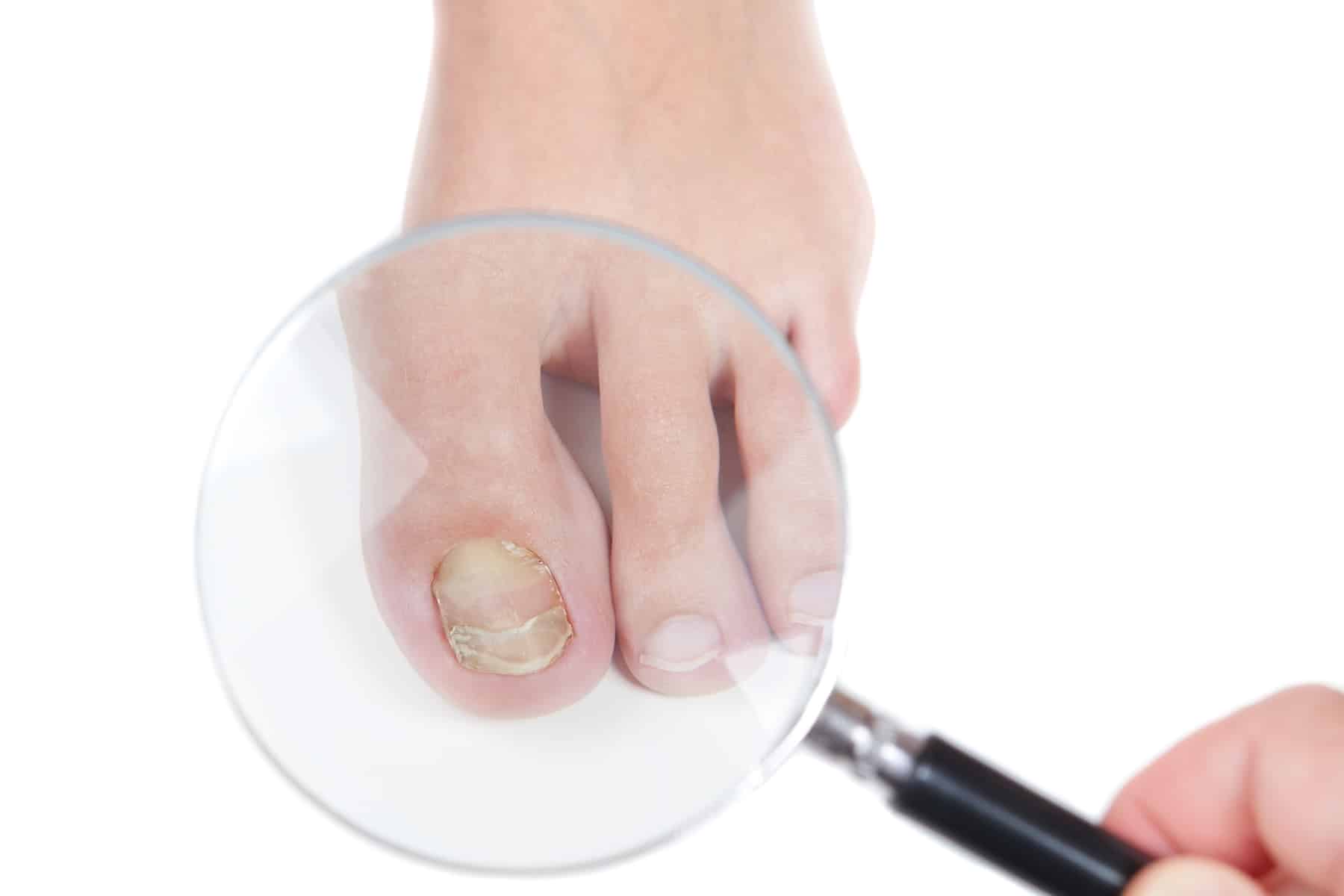 Nail Psoriasis Vs Fungus Understanding The Differences And Symptoms Reflexologyhistory